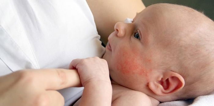 Ruam Susu Di Muka Bayi: Ini Cara Untuk Atasi Ruam