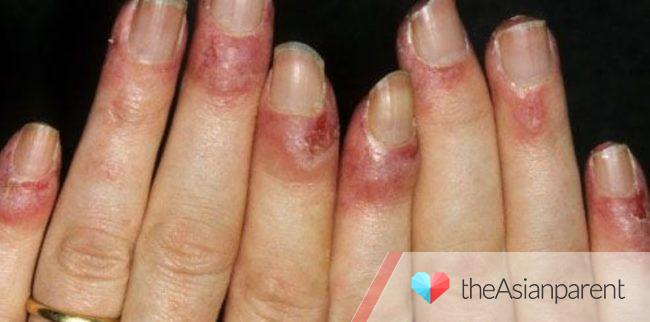 Penularan Virus HIV Melalui Manicure Yang Dikongsi Bersama Sepupu