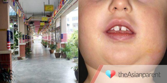 Penyakit Beguk: 7 Simptom Beguk Yang Anda Perlu Tahu