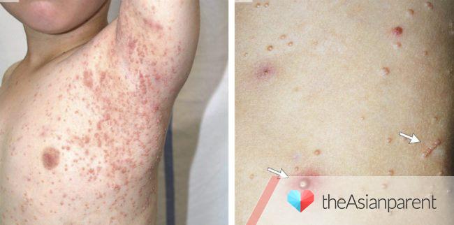 Molluscum Contagiosum, Ini Punca Penyakit, Gejala & Rawatannya