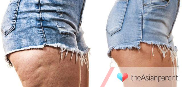 Proven Ways to Get Rid of Cellulite With These Natural Remedies