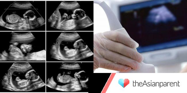 Detail Scan Bayi Penting Kesan Sebarang Keabnormalan, Elak Komplikasi