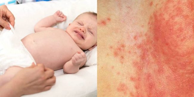 Ruam Merah Pada Bayi Akibat Kesalahan Dalam Penggunaan Lampin