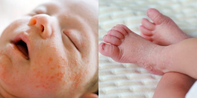 Ruam Bayi Baru Lahir, Mana Yang Selamat & Yang Perlukan Rawatan