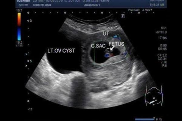 Tanda Cyst Atau Fibroid Ketika Hamil, Selamatkah Jika Buat Pembedahan