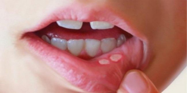 Ubat Ulser Mulut Boleh Datangkan Bahaya Pada Kanak-Kanak, Hati-Hati!