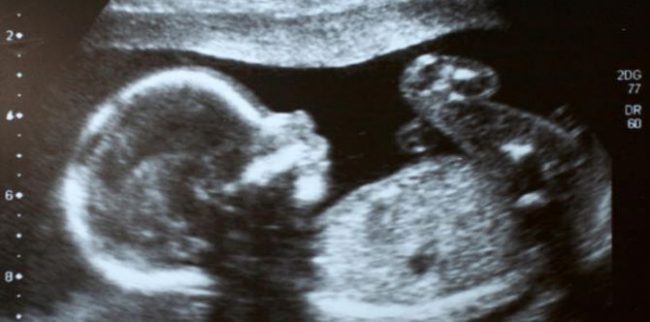 Scan Baby Penting Untuk Ketahui Perkembangan Bayi Dalam Kandungan