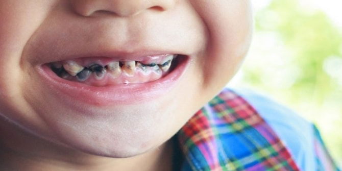 Gigi Anak Rosak Mungkin Sebab 13 Perbuatan Ibu Bapa InI!