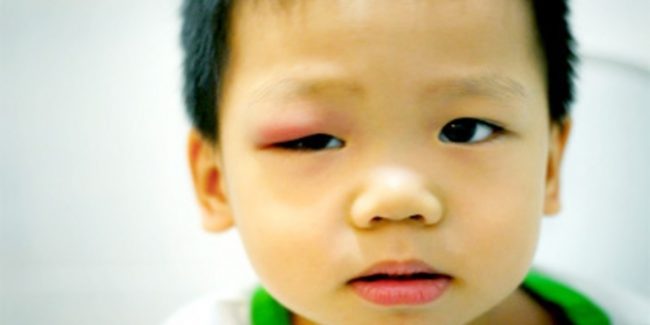 Ketumbit Mata: Petua Hilangkan Ketumbit Mata Pada Bayi & Kanak-Kanak