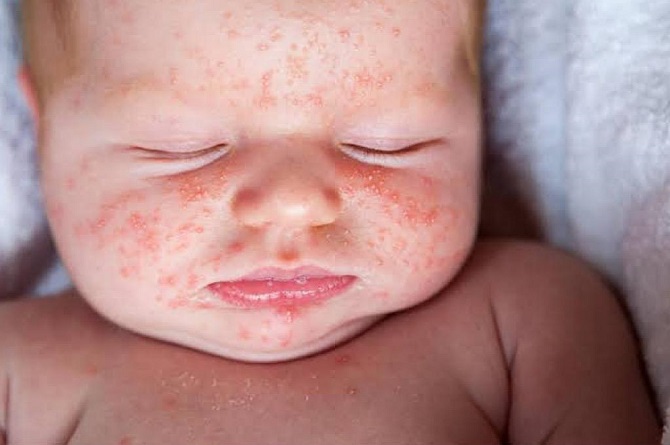Jenis Ruam Bayi Baru Lahir,Ada Yang Gatal & Tidak, Take Note Ibu Ayah