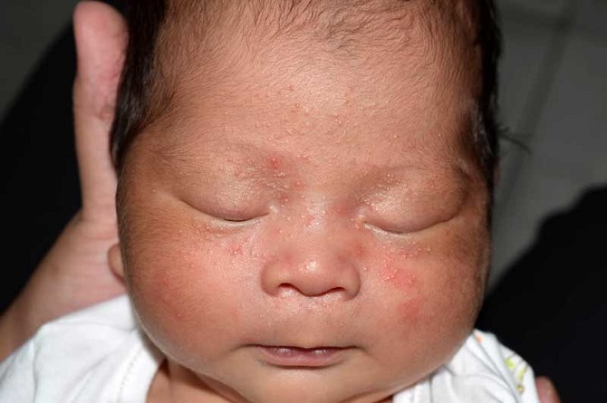 Jenis Ruam Bayi Baru Lahir,Ada Yang Gatal & Tidak, Take Note Ibu Ayah