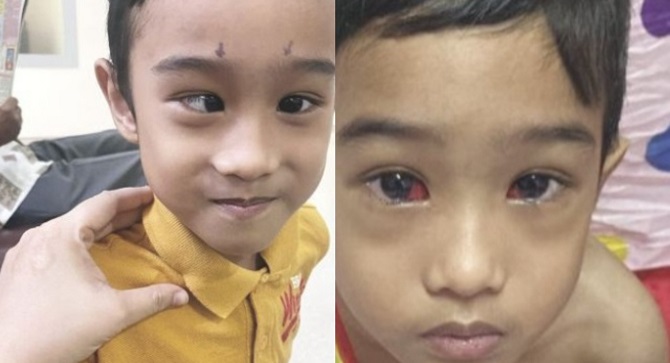 Punca Mata Juling, Ibu Akui Kesal Terlalu Lama Bagi Anak Main Telefon