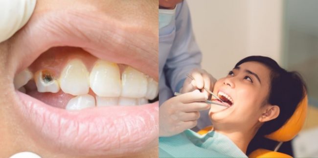 Gigi Hitam Berpunca Dari Plak: Gejala, Punca & Rawatan