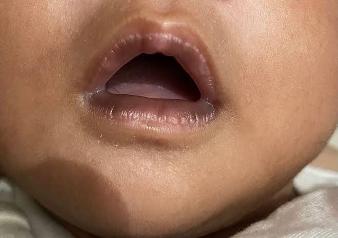 Bibir Bayi Hitam, Parents! Jangan Risau, Ini Apa Anda Perlu Tahu