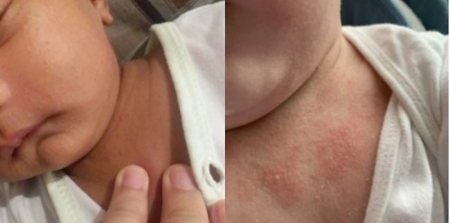 Ruam Panas Bayi Dan Kanak-Kanak: Punca, Gejala, Rawatan