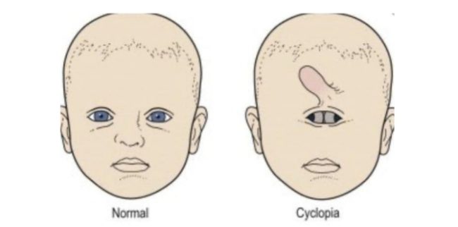 Sindrom Cyclopia: Bayi Cyclops Satu Mata Dan Tiada Hidung